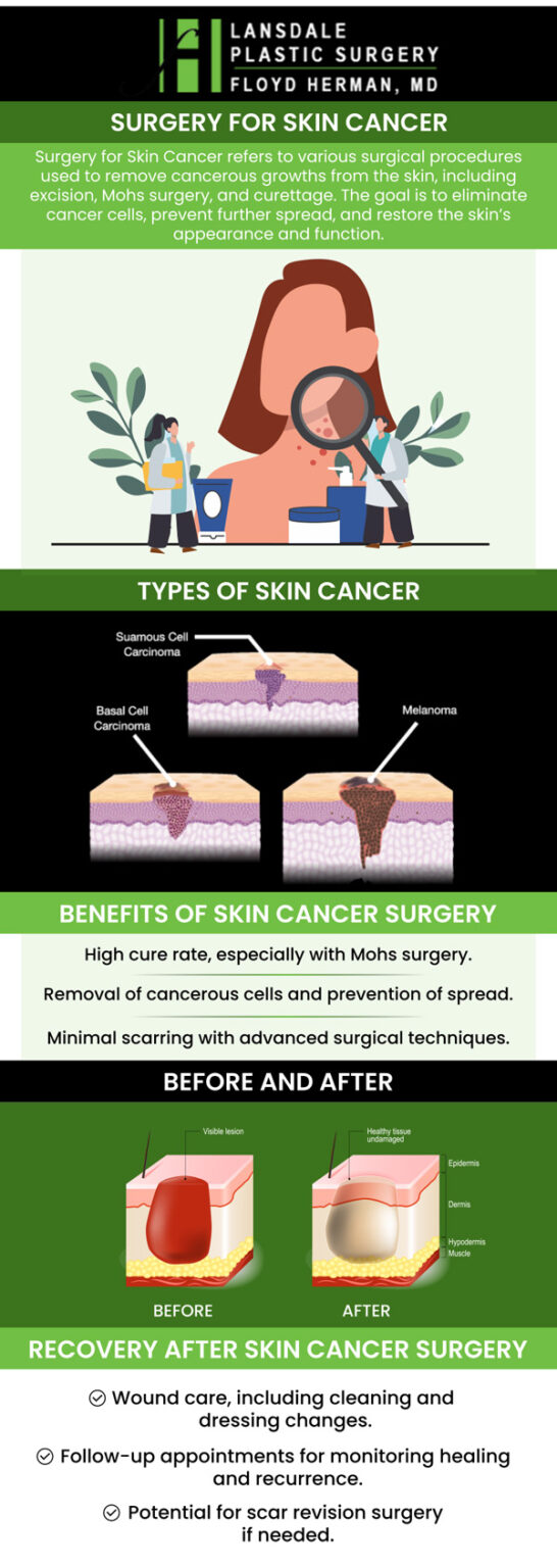 Skin Cancer Removal Surgery Serving Colmar, Lansdale PA